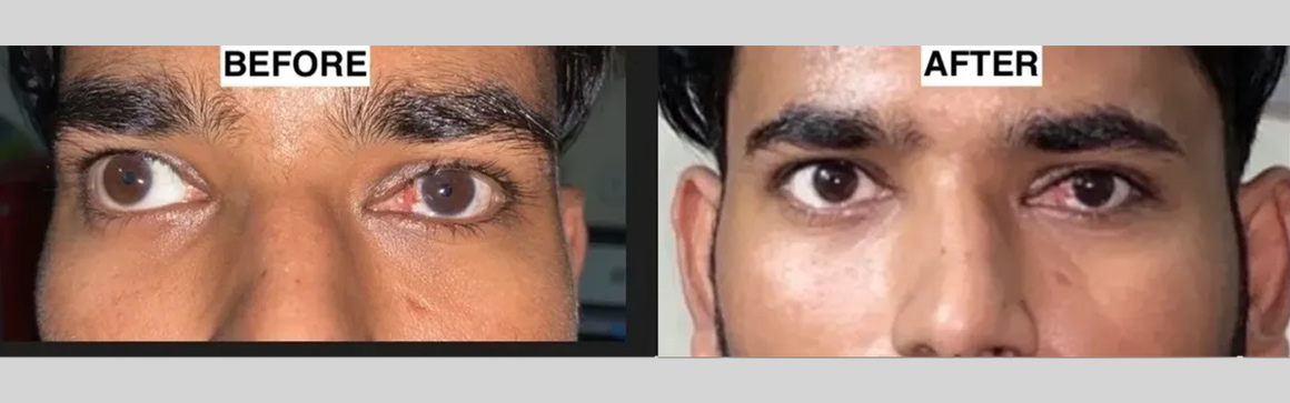 Squint Treatment - Tewari Eye Centre