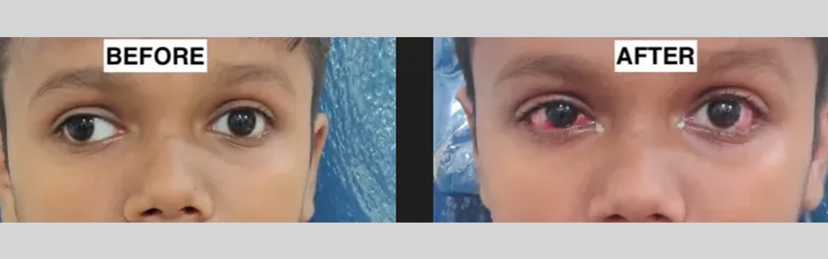 Squint Treatment - Tewari Eye Centre