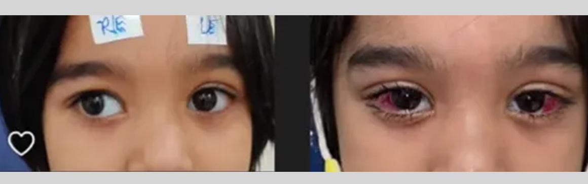 Squint Treatment - Tewari Eye Centre