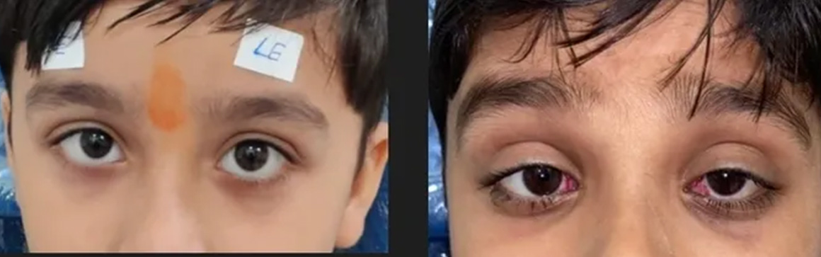 Squint Treatment – Tewari Eye Centre